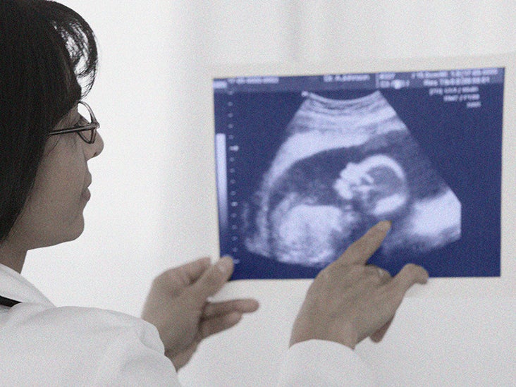 Beckwith-Wiedemann syndrome: Causes, symptoms, treatment, and more