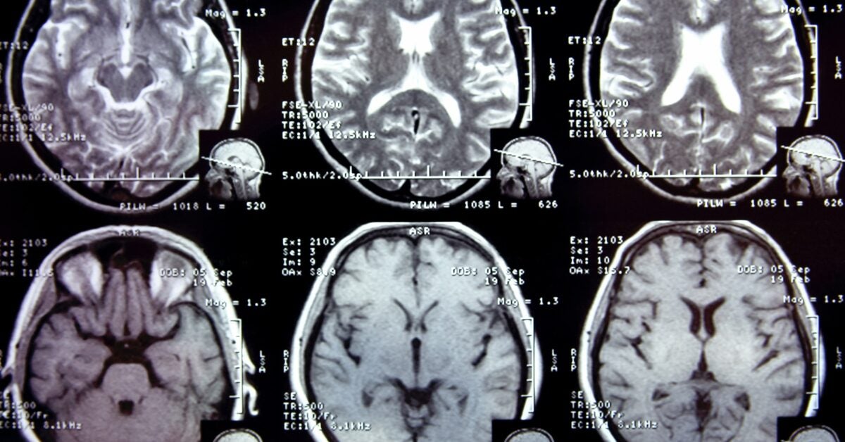 Gender Differences Found in Brains of Sleep Apnea Patients